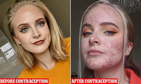Nikki Birth Control Pills Acne Skincare Journey After Birth Control