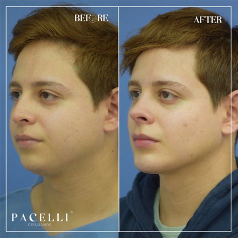 Nuestro Paciente Buscaba Un Aspecto Pacelli Cirujanos