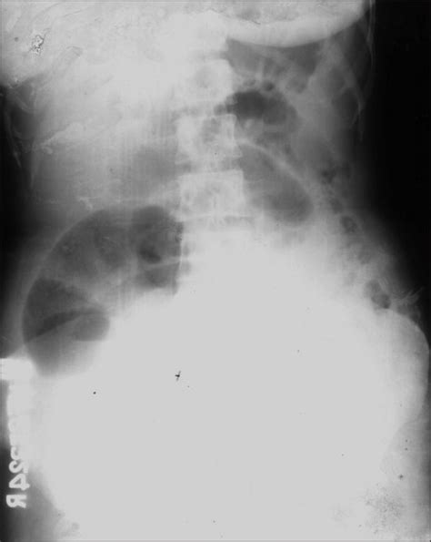 Abdominal Radiograph Reveals A Large Gas Filled Loop Of The Bowel In