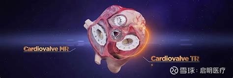 经典病例回顾 Cardiovalve一瓣双“雕” ，启明医疗四瓣一体全系列瓣膜方案新突破 Cardiovalve近日，杭州启明医疗器械股份