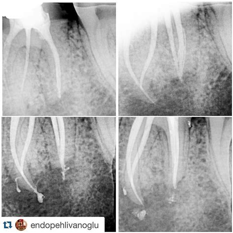 Successful Retreatment Of Lower Molar With Periapical Lesion