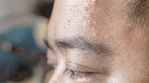 How Dangerous Are Shingles In The Elderly Entirely Health