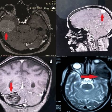 Mri Brain Showing Extraaxial Contrast Enhancing Lesion At A Frontal