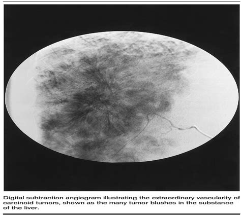 Embolization And Chemoembolization Therapy For Neuroendocrin