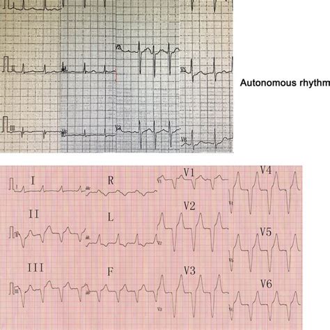 Typical Ecg Of Leadless Pacing In The Low Ventricular Septum The Basal
