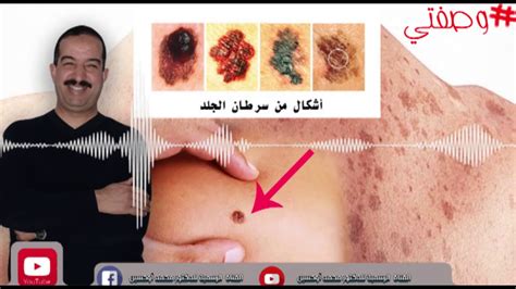 علامات لو ظهرت بجسمك اعرف أنك مصاب بسرطان الجلد Youtube
