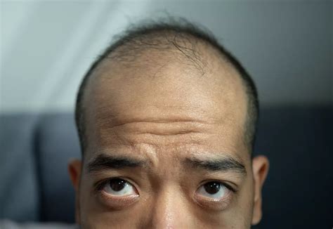 Scientists Say We Could Be On The Brink Of A Cure That Will Stop Balding