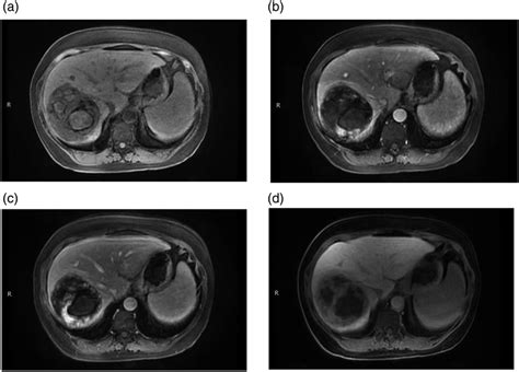 An Abdominal Magnetic Resonance Imaging Scan Of A 52 Year Old Woman