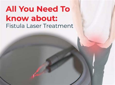 All You Need To Know About Fistula Laser Treatment