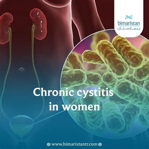 Chronic Cystitis In Women In Turkey بيمارستان