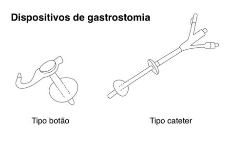 Gastrostomia Percutanea