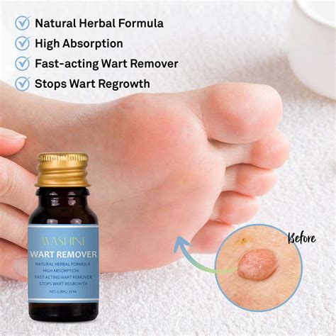Anlome Wart Removal Painlessly Removes Common Hand And Plantar Wart