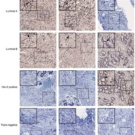Expression Of Er Pr And Her 2 In Different Subtypes Of Breast Cancer