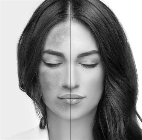 Skin Hyperpigmentation Types Causes And Treatments La Beauty Skin Center