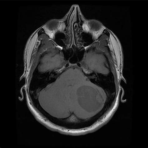 Cerebellar Hemangioblastoma Image