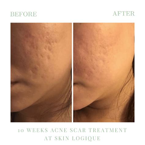 How To Get Rid Of Pitted Acne Scars