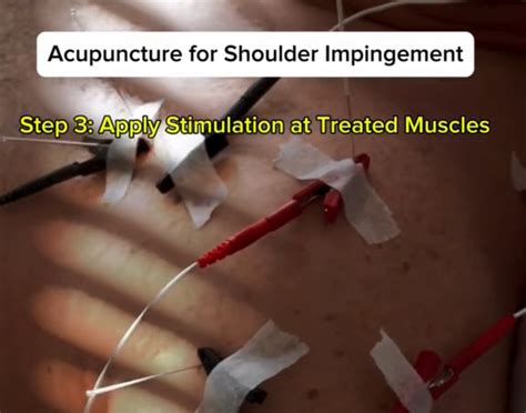 Understanding Shoulder Impingement Syndrome And The Role Of Acupuncture