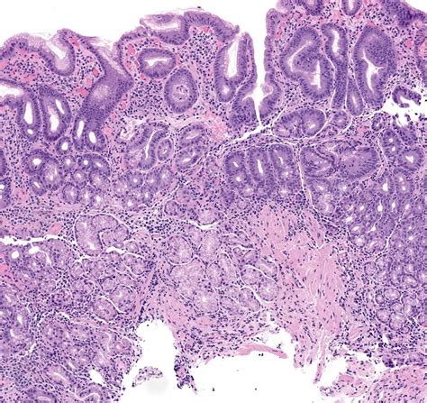Atrophic Gastritis Pathology
