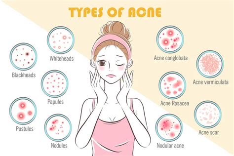 Nodular Acne Vector Art Stock Images Depositphotos