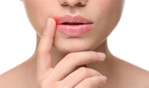 Canker Sore Diet 9 Foods You Need To Avoid