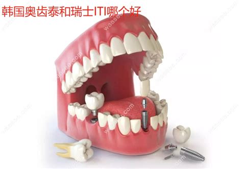 韩国奥齿泰和瑞士iti哪个好osstem价格便宜士卓曼植体寿命长 口腔资讯 牙齿矫正网