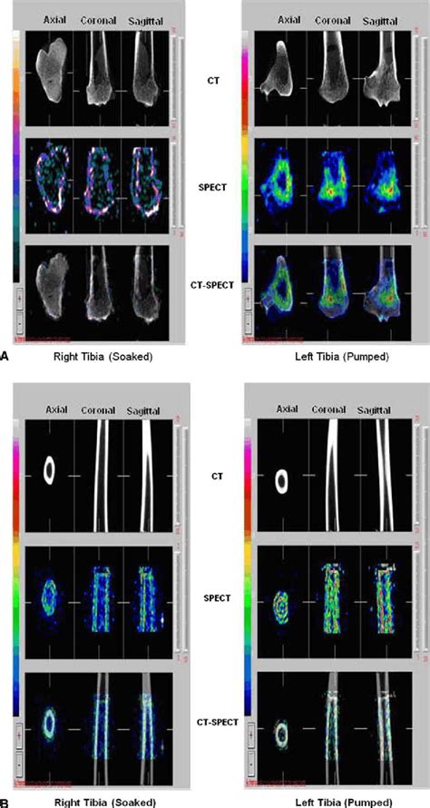 A B A Soaked Versus Pumped Tibia Metaphyseal Ct Image Metaphyseal Download Scientific