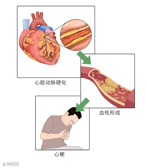 冠心病 医学插画