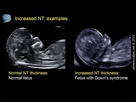 Nuchal Translucency Screening What To Expect How To Measure Nuchal