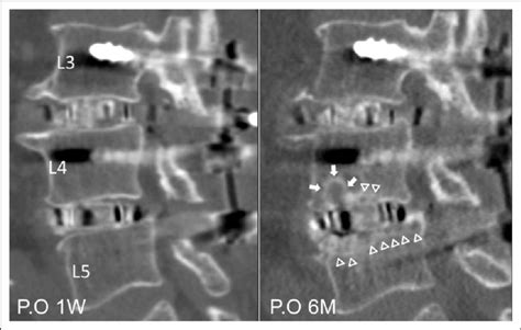 A Typical Example Of A Vertebral Endplate Cyst Formation In The