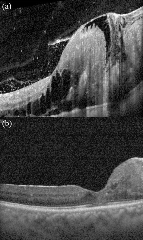 A Macular Sd Oct Prior To Surgery Bcva 20800 B Macular Sd Oct