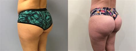 Brazilian Butt Lift Dangerous Brazilian Butt Lift The Ultimate Bbl Surgery Guide Nvhj