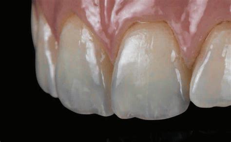Try Zirtek Zirconia