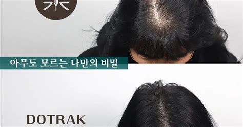 Smp 시술 포트폴리오 에이든 숨고 숨은고수
