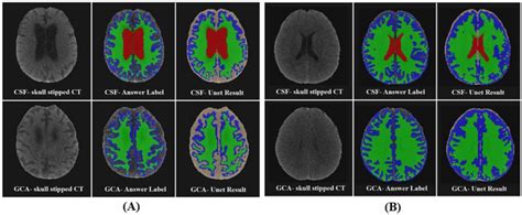 Sample Of Segmentation Result A Alzheimers Dementia B Normal Download Scientific Diagram