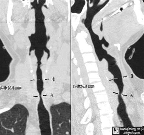 Learning Radiology Tracheal Stenosis