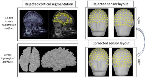 Case Example For The Quality Control Of Cortical Segmentation And