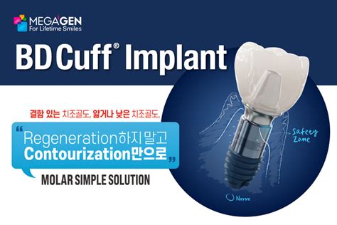메가젠 새 임플란트 출시 “골결손부 간단 해결”