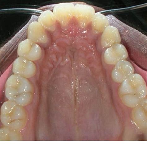 Pdf Surgical Management Of Transverse Maxillary Deficiency In Adults