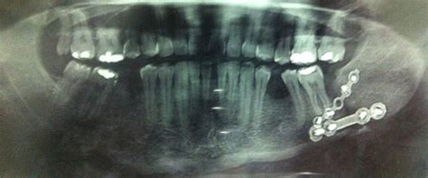 Clínica Lincoln Fractura Cuerpo Mandibular Derecho Presentación De Un