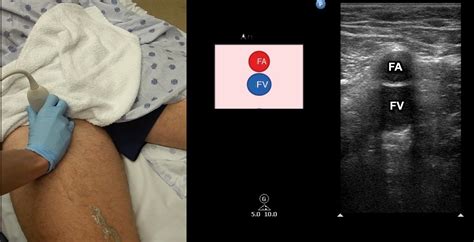 Proximal Superficial Femoral Vein