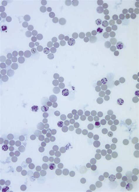 Pin De Danielle Nascimento En Hematologia En 2024 Hematología