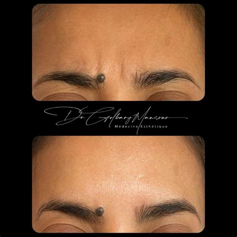 Best Glabella Botox Injections In Montreal Clinique Esthétique Homa