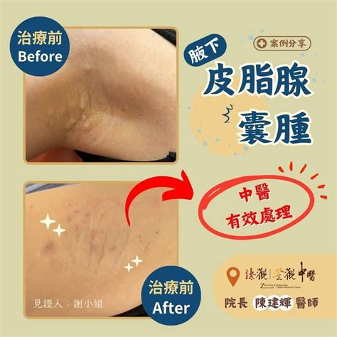 「皮脂腺囊腫｜案例分享」永和 臻觀中醫｜台北、台中 澄觀中醫診所~ 皮膚科 案例分享 閒聊板 Dcard