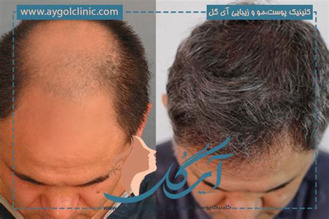 آشنایی با روش‌های کاشت مو Fit، Fut و ترکیبی