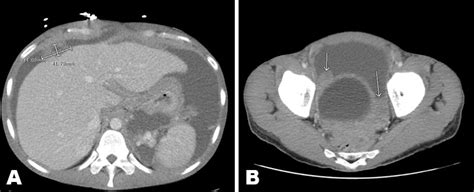 A And B Ct Abdomen Demonstrating Large Volume Ascites And Multiple