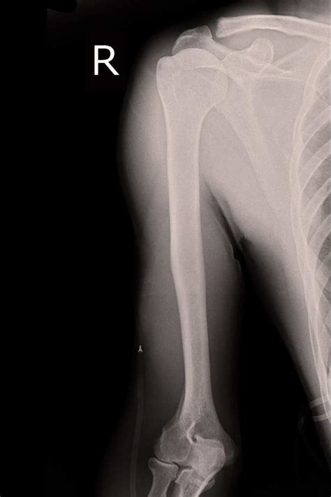 Labeled Humerus Xray Anatomy Lateral View Anatomy Gre