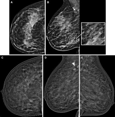 False Positive And False Negative Contrast Enhanced Mammograms