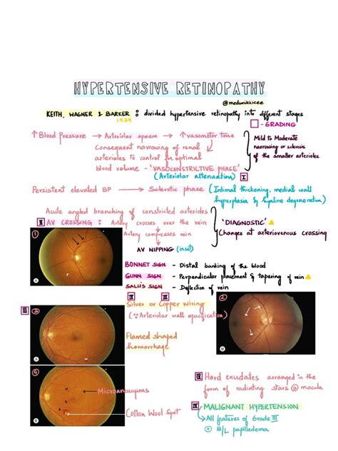 grading and staging of hypertensive retinopathy the 1939 keith wagner