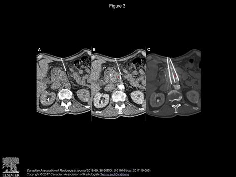 Irreversible Electroporation In Hepatopancreaticobiliary Tumours Ppt