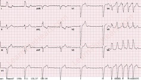 Electrocardiogram Ekg Gm Rkb